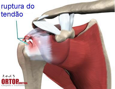 Manguito Rotador - Cirurgia e Tratamento em Curitiba